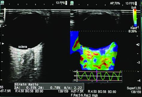B Mode Ultrasonography Image 1 And The Related Elastography Image 2