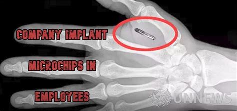 직원들에게 마이크로칩을 이식하는 기술 회사 Unnews 유엔뉴스 유엔신문