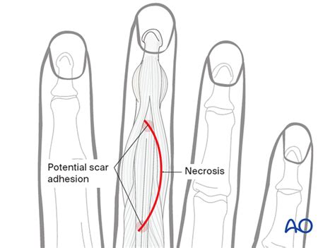 Dorsal Approaches To The Proximal Interphalangeal Joint