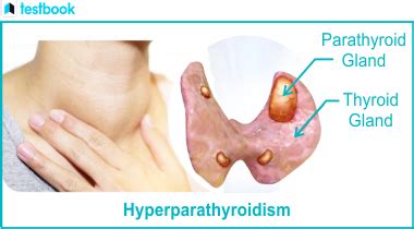 Understanding Hyperparathyroidism Causes Symptoms Diagnosis And