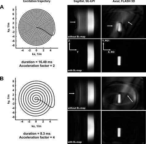 3 Excitation Of Limited Slices Encoded By Spiral Trajectories On The 3