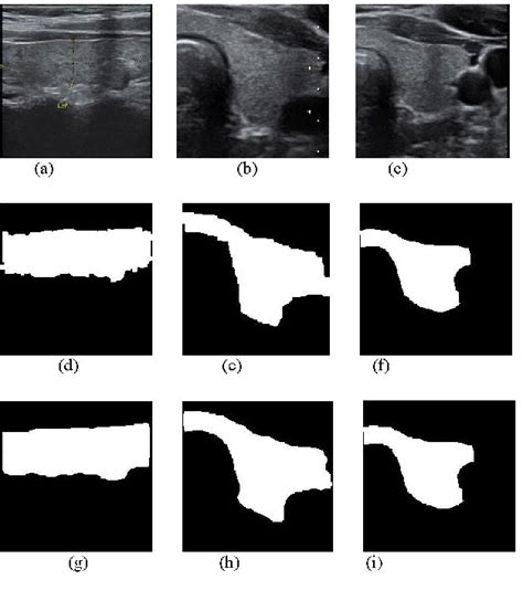 Figure 4 From Segmentation Of Thyroid Gland In Ultrasound Image Using Neural Network Semantic