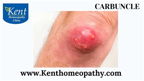 Carbuncle Kenthomoepathy Powai Mumbai Homeopathy Doctor