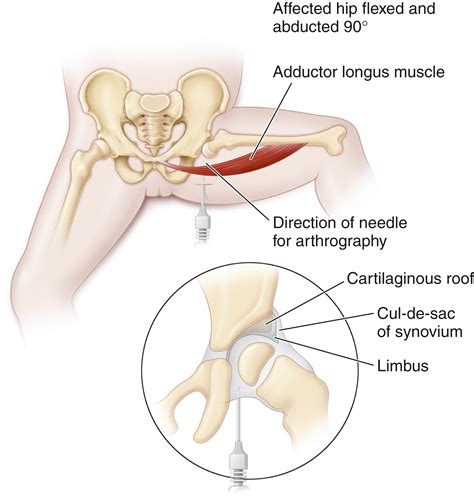 Developmental Dysplasia Of The Hip Clinical Tree