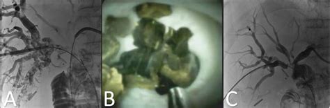 A Cholangiogram Showing Extensive Intrahepatic Stone Burden B