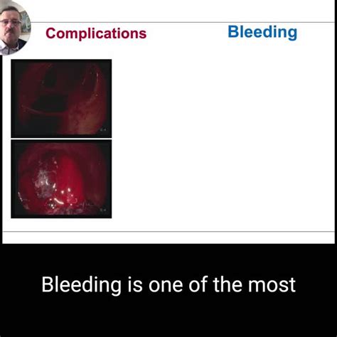 Video Endocollab™ Gi Endoscopy Education On Linkedin Post