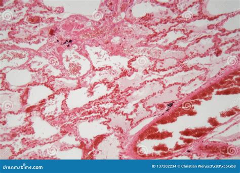 Lung Tissue With Pneumonia Infection Caused By Flu Viral Pneumonia