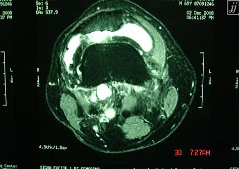 Msk Popliteal And Supra Popliteal Cyst 4 Radioogle
