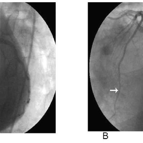 Systolic Compression At The Mid Portion Of Lad At The Lao View A Download Scientific Diagram