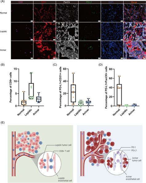 Spatial Transcriptomics Reveals Heterogeneity Of Histological Subtypes Between Lepidic And