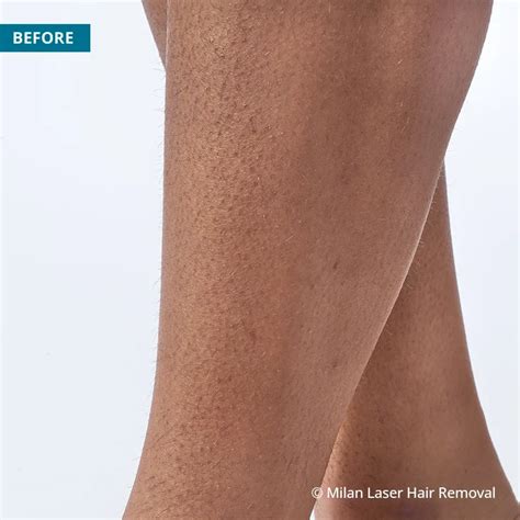Legs And Feet Before After Photos Of Laser Hair Removal Milan Laser In Green Bay Wi