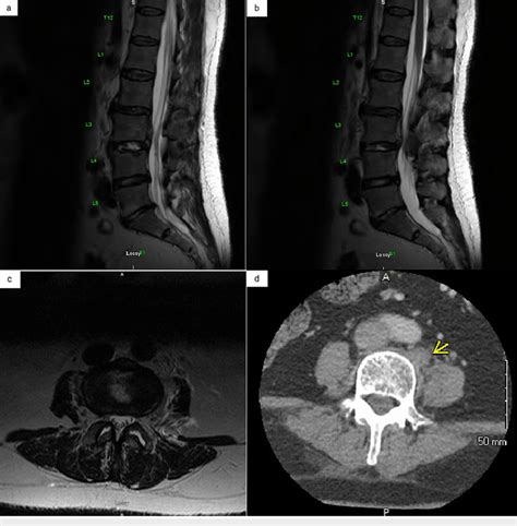 Lumbar Spine Mri A B C And Ct D With Contrast A Marked T2 Download Scientific Diagram