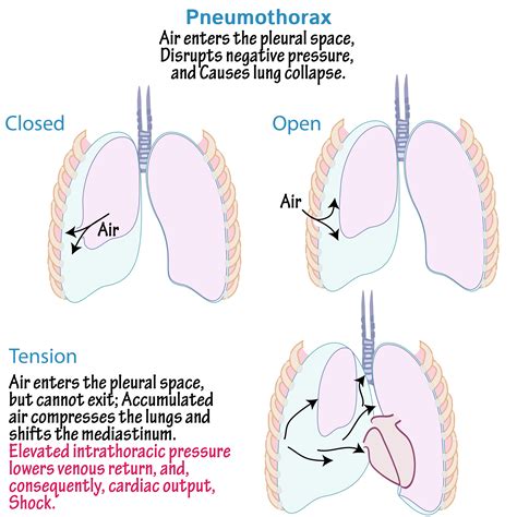 Open Pneumothorax Delayed Pneumothorax After Bronchoscopy In A Lung