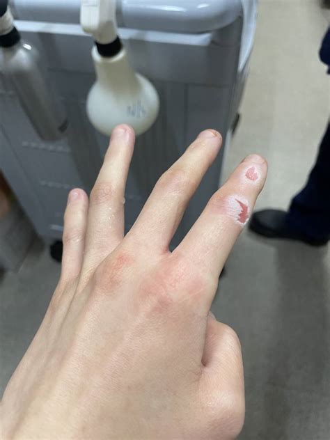 [잡담] 화상 3일차인데 심한거 같아 혐오주의 인스티즈 Instiz 일상 카테고리