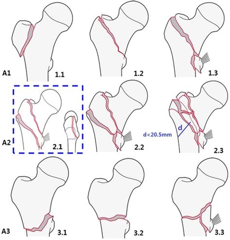Classification Of Hip Fractures 1 Femoral Neck
