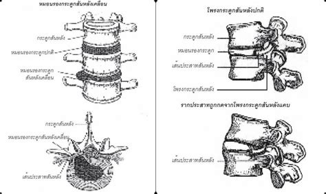 หมอนรองกระดูกเคลื่อน