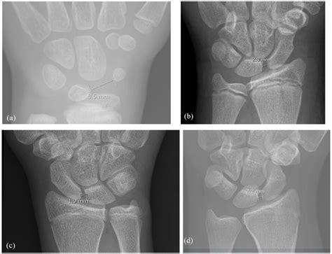 Radiographic Scapholunate Interval In The Pediatric Population