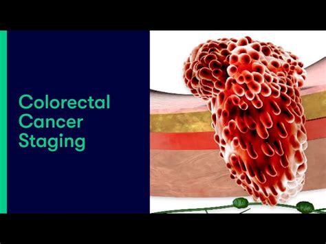 Colon Cancer Staging A Guide To Understanding Your Diagnosis Cancerwalls