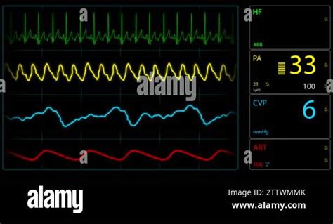 Looped Patient Monitor Displays Vital Signs Ecg Electrocardiogram Ekg Oxygen Saturation Spo2