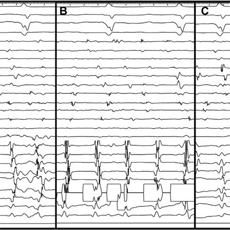 A Intracardiac Recordings From The Circular Mapping Catheter Download Scientific Diagram