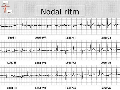 Ppt Ekg Powerpoint Presentation Free Download Id 6700262