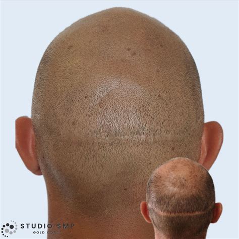 Smp For Hair Transplant Scars Gold Coast Fue And Fut Scar Camouflage
