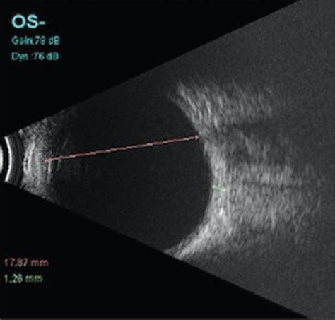 Ultrasound B Scan In Pediatric Glaucoma Ihope Journal Of Ophthalmology