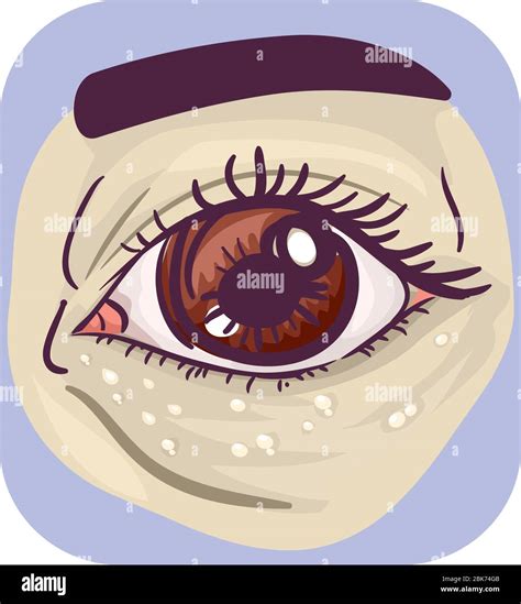Bump Under Skin By Eye At Hudson Slattery Blog