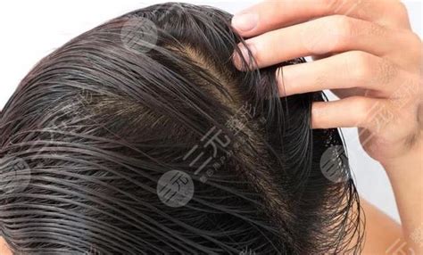 【脱发】头发油腻是什么原因？油腻性脱发可以进行植发手术吗？护发秘籍时尚 健康 初颜网