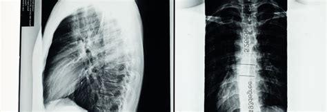 რა არის სქოლიოზი