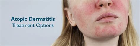 Trattamento Della Dermatite Atopica Consigli Degli Esperti Per Gestire