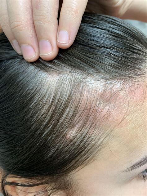 Multiple Bald Spots On My Right Temple Side Im At A Huge Loss My Hair Loss Has Drastically