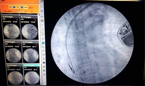 Pacemaker Implantation Trust Multispeciality Hospitals