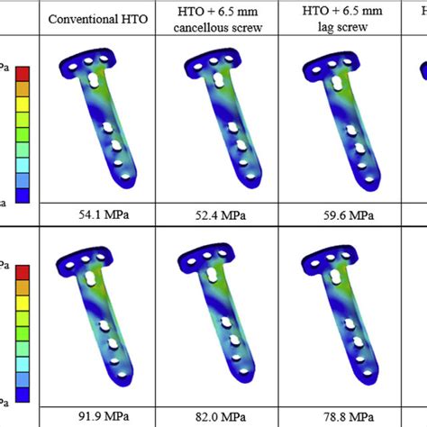 The Model Assembly Of The High Tibial Osteotomy Model With A Commercial Download Scientific