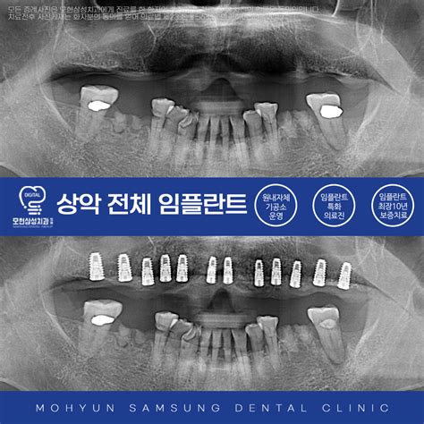 모현삼성치과의원 상악 전체 임플란트 더 안전하게 부모님 효도임플란트는 모현삼성치과에서