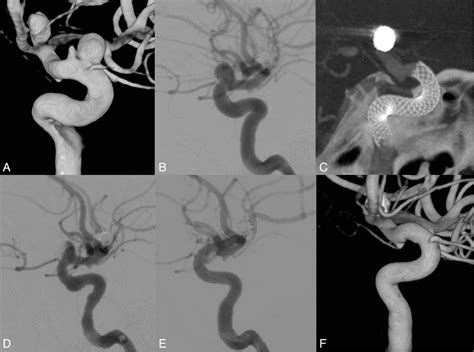 Figure 1 From A Dsa Based Method Using Contrast Motion Estimation For The Assessment Of The