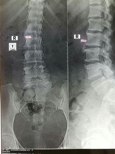 Lower Back Scoliosis Xray Mapasgmaes