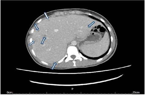 Ct Abdomen Showing Multiple Miliary Nodules Tubercules Indicated By Download Scientific