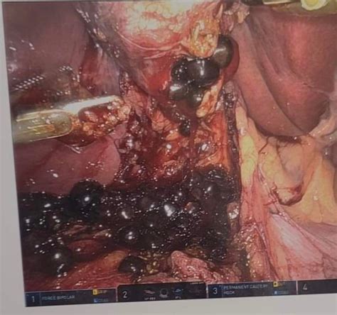 Got My Gallbladder And Appendix Removed At The Same Time Yesterday