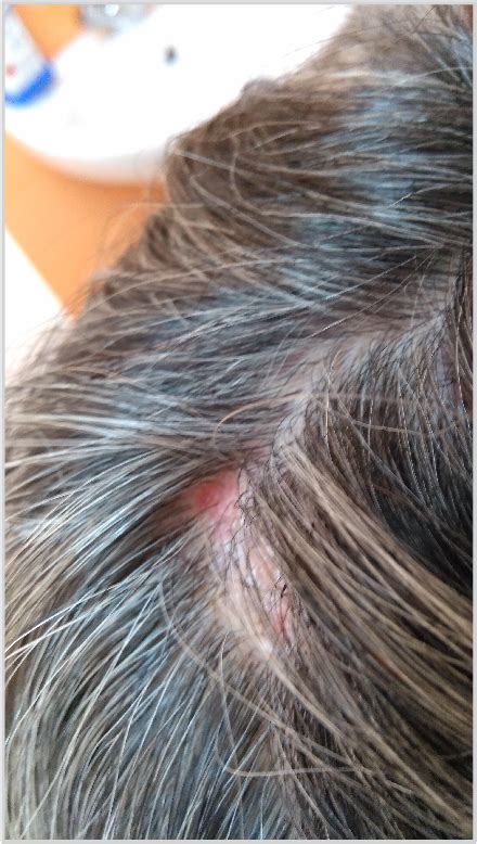 Erosive Pustular Dermatosis Of The Scalp Semantic Scholar