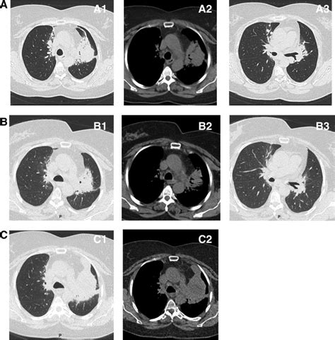 Smad4 Mutation In Small Cell Transformation Of Epidermal Growth Factor Receptor Mutated Lung