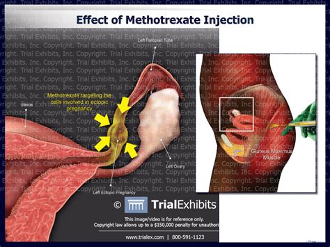 Effect Of Methotrexate Injection Trialquest Inc