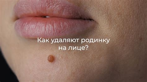 Удаление родинки на лице Как это делают Youtube