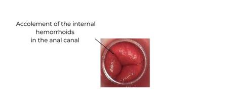 Internal Hemorrhoids Piles Coloproctologie