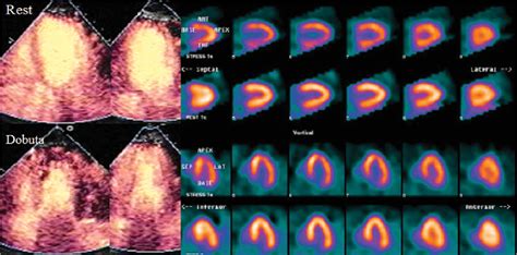 Figure 1 From Myocardial Perfusion Defects In Patients With Autoimmune Diseases A Prospective