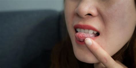 Dentists Reveal What Causes Those Weird Painful Bumps On Your Tongue