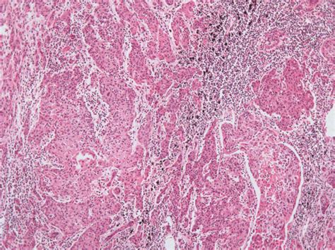 Photomicrography Of Mediastinal Lymph Node Showing Effacement Of The Download Scientific
