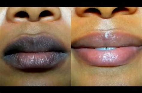 How To Remove Dark Colour From Lips
