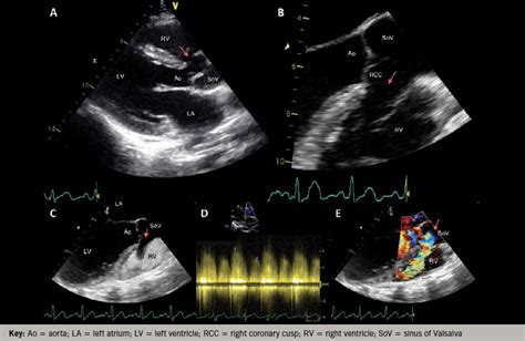 Aortic Sinus