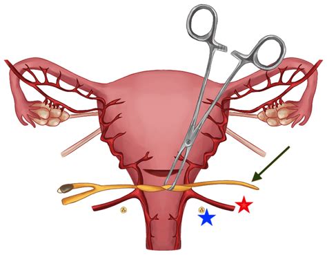 Uterine Artery Embolization For Postpartum Hemorrhage